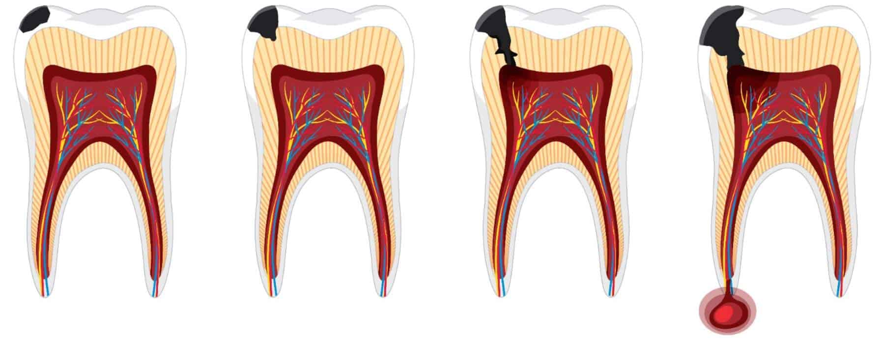 How Does Sugar Affect Your Teeth? - Dr. Roland Zhuka