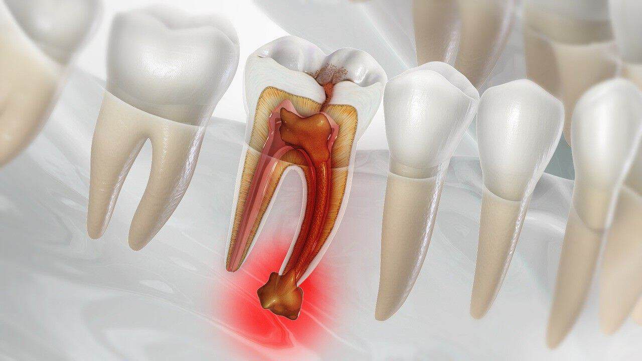 Dealing With Dental Abscesses: Symptoms, Risks, And Treatments