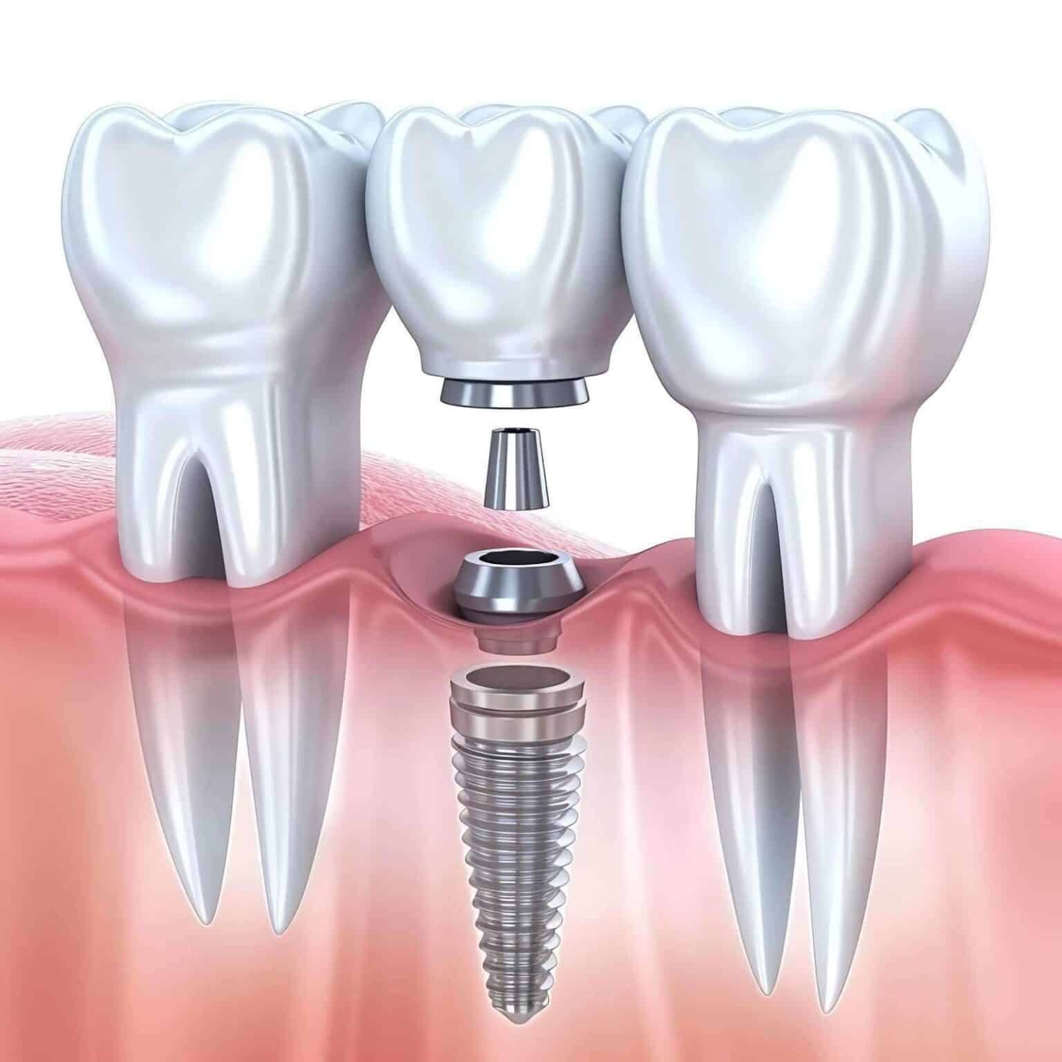 Peri-Implantitis: Causes, Symptoms, And Treatment Options