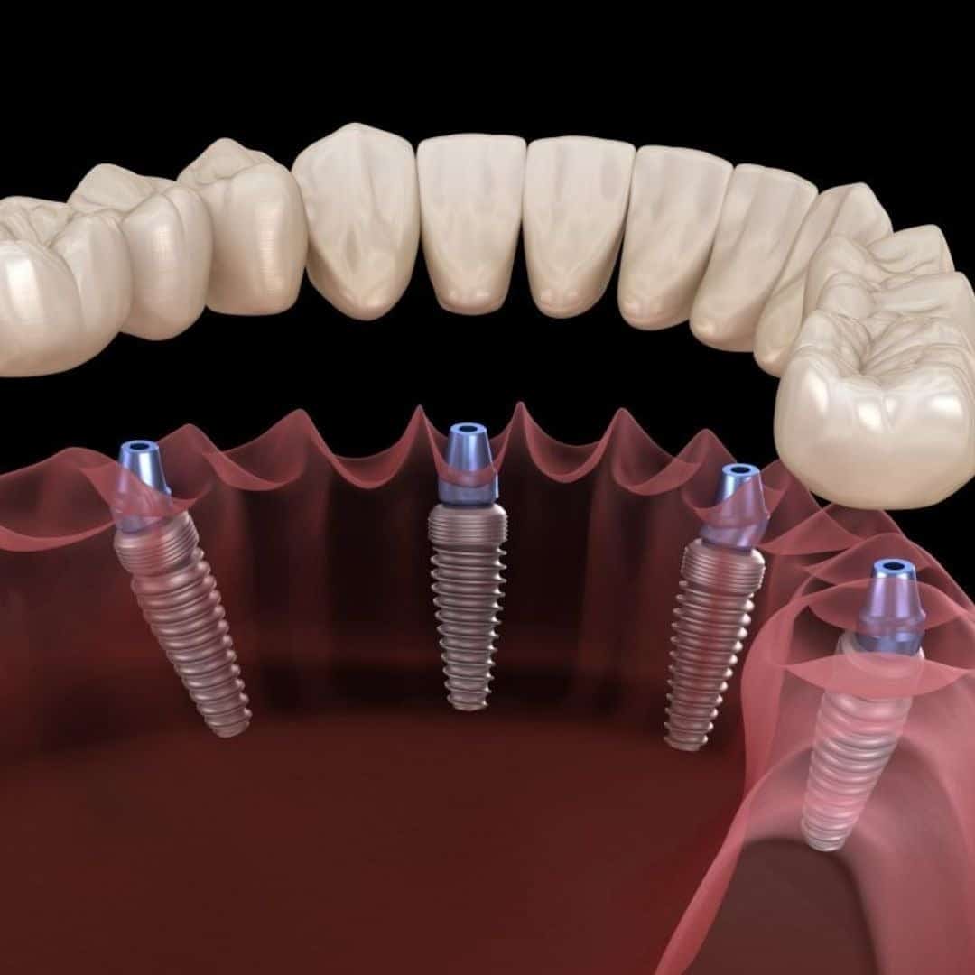All-On-4, All-On-6 & All-On-8 Implants in Albania